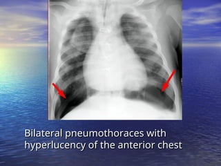 Paediatrics-Chest-radiology spotters.ppt