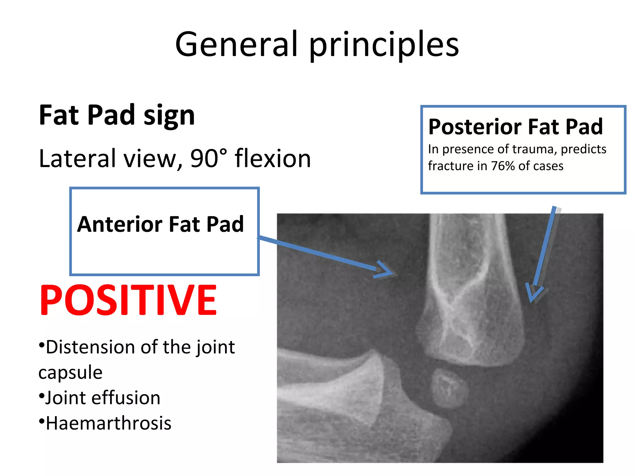 paediatric elbow fractures | PPT