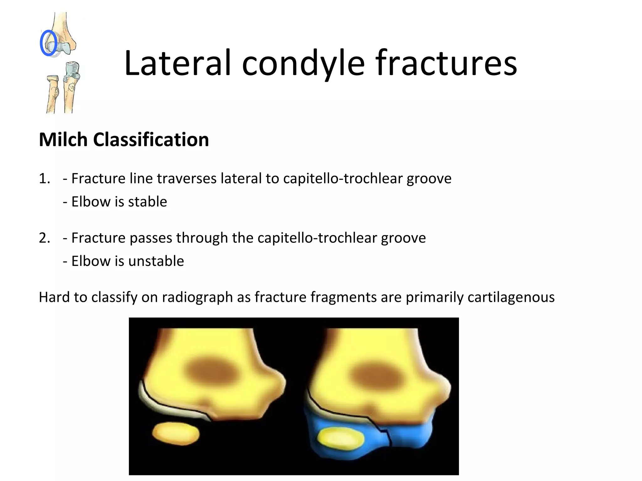 paediatric elbow fractures | PPT