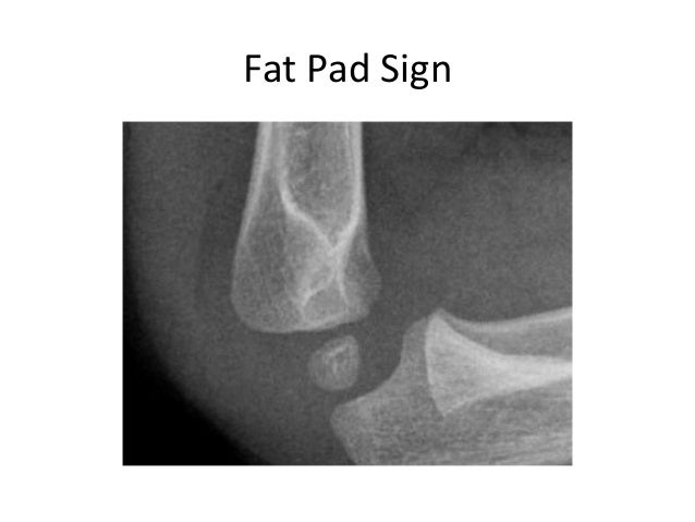 paediatric elbow fractures