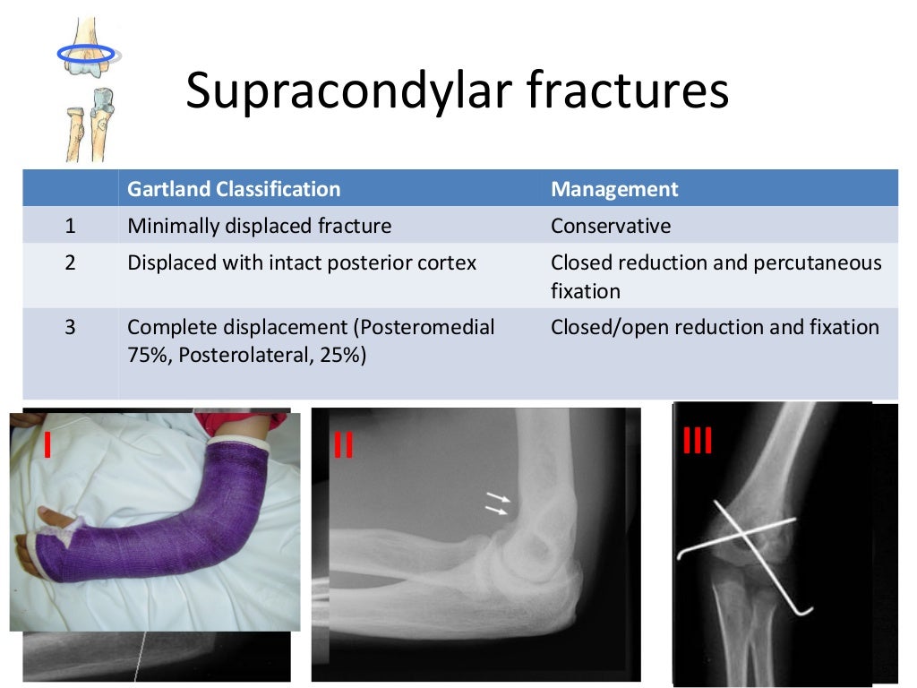 Paediatric Elbow Fractures
