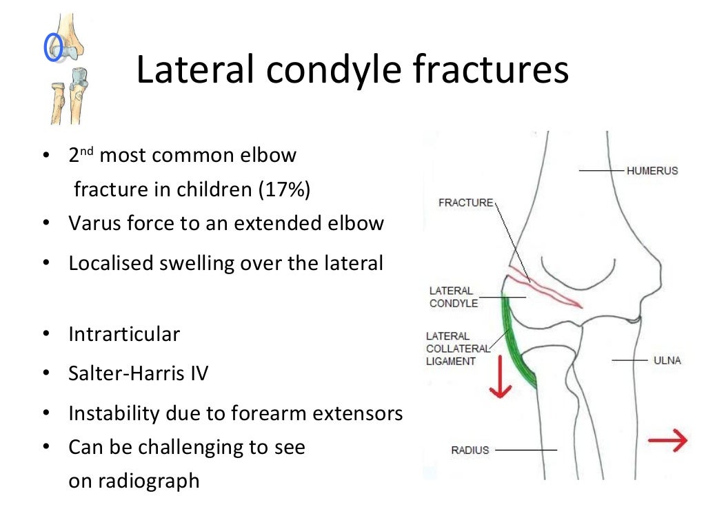 Paediatric Elbow Fractures