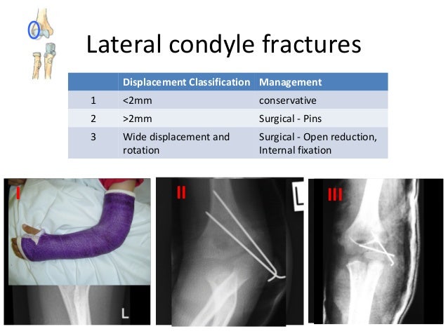 paediatric elbow fractures