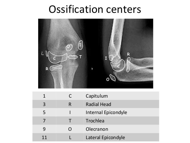 Paediatric Elbow Fractures