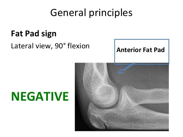 Paediatric Elbow Fractures