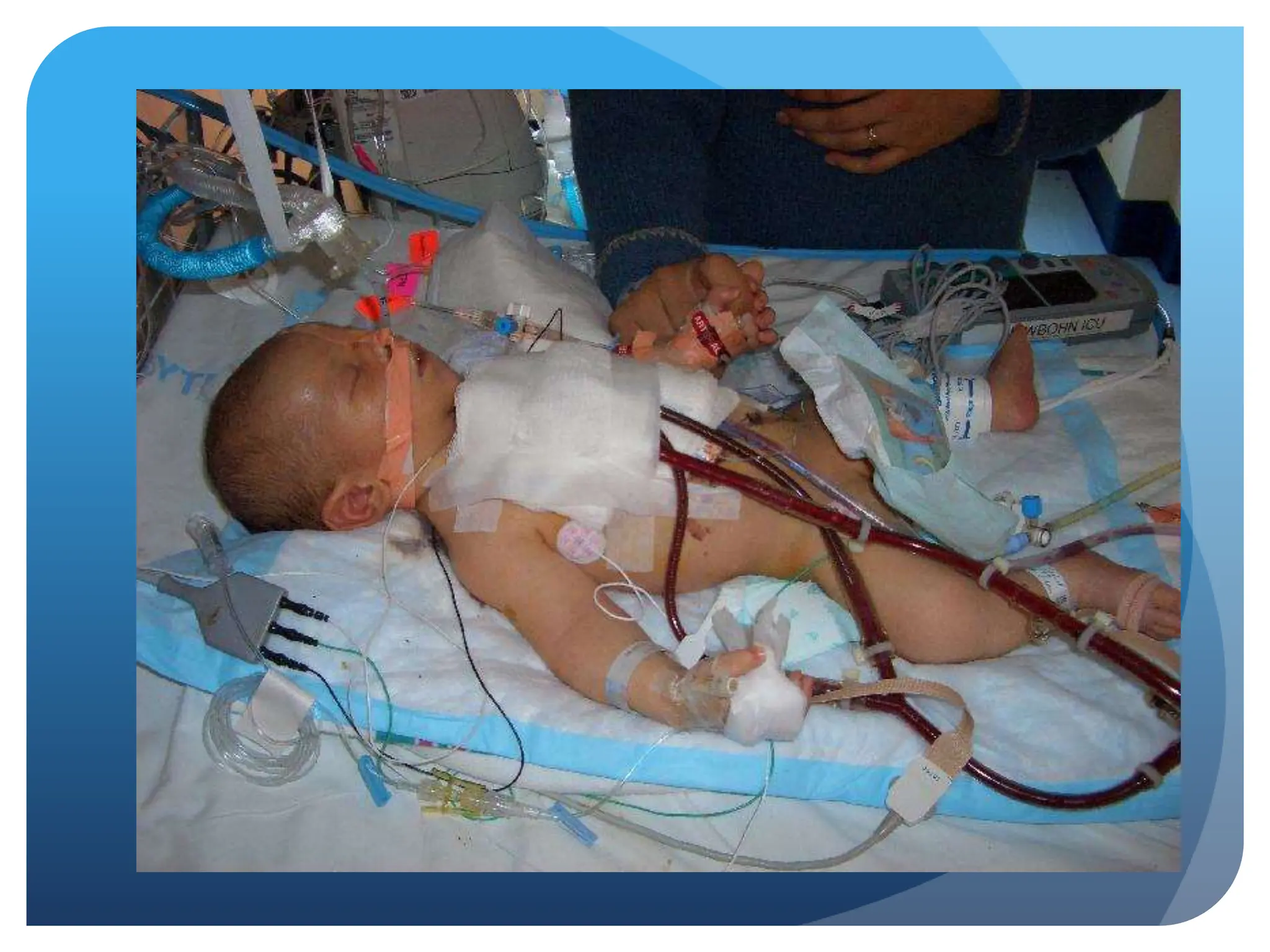 paediatric-septic-shock very rare condition to the baby | PPTX