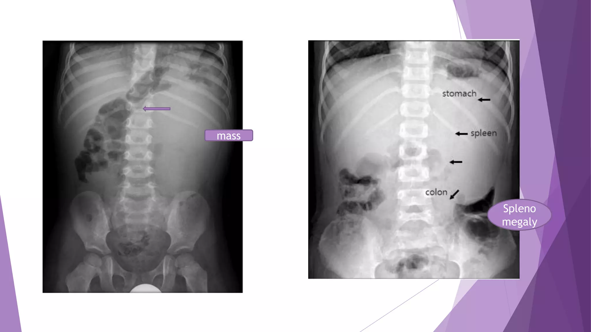 Paediatric abdominal x-ray-A key to diagnosis.pptx