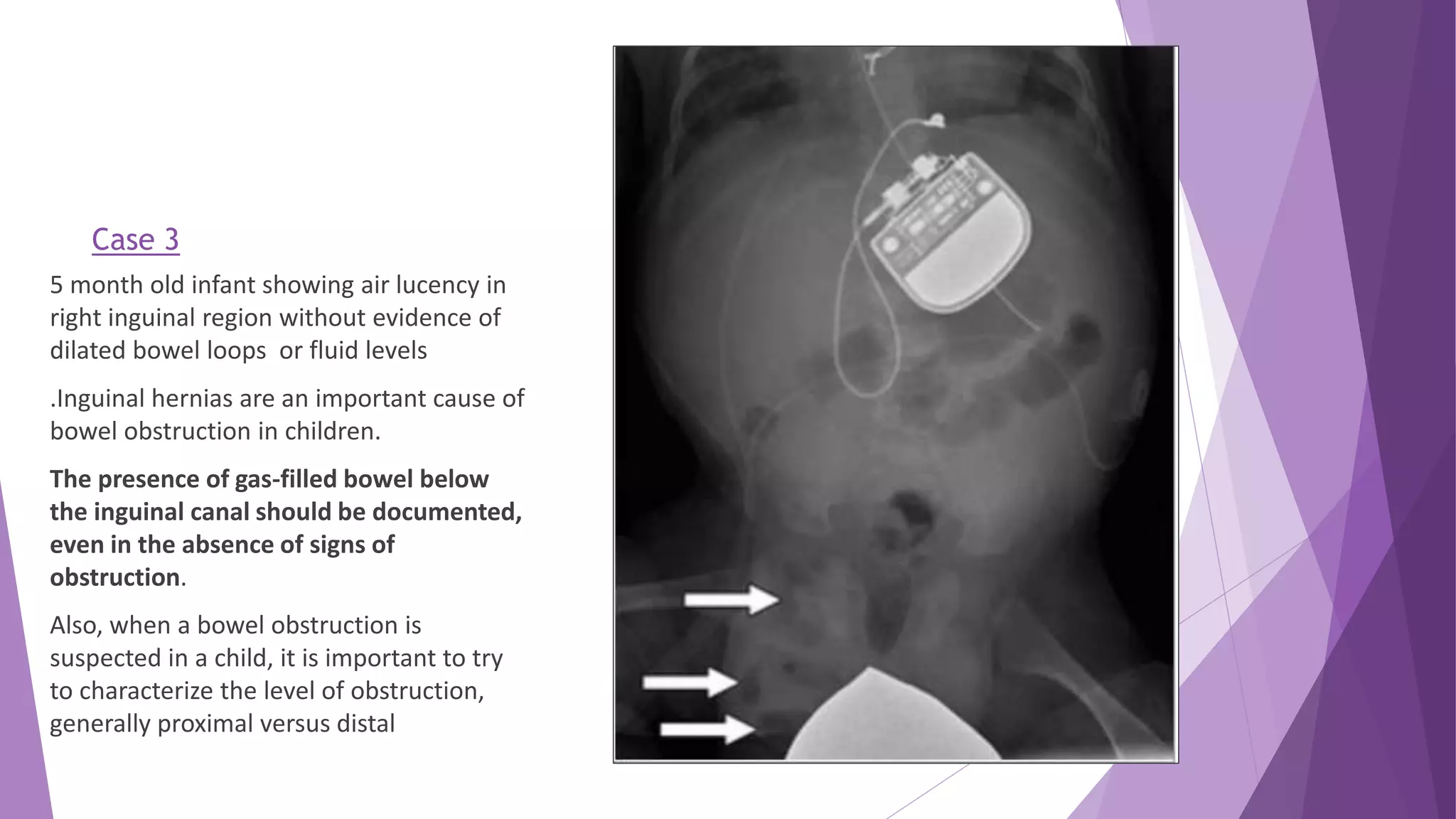 Paediatric abdominal x-ray-A key to diagnosis.pptx