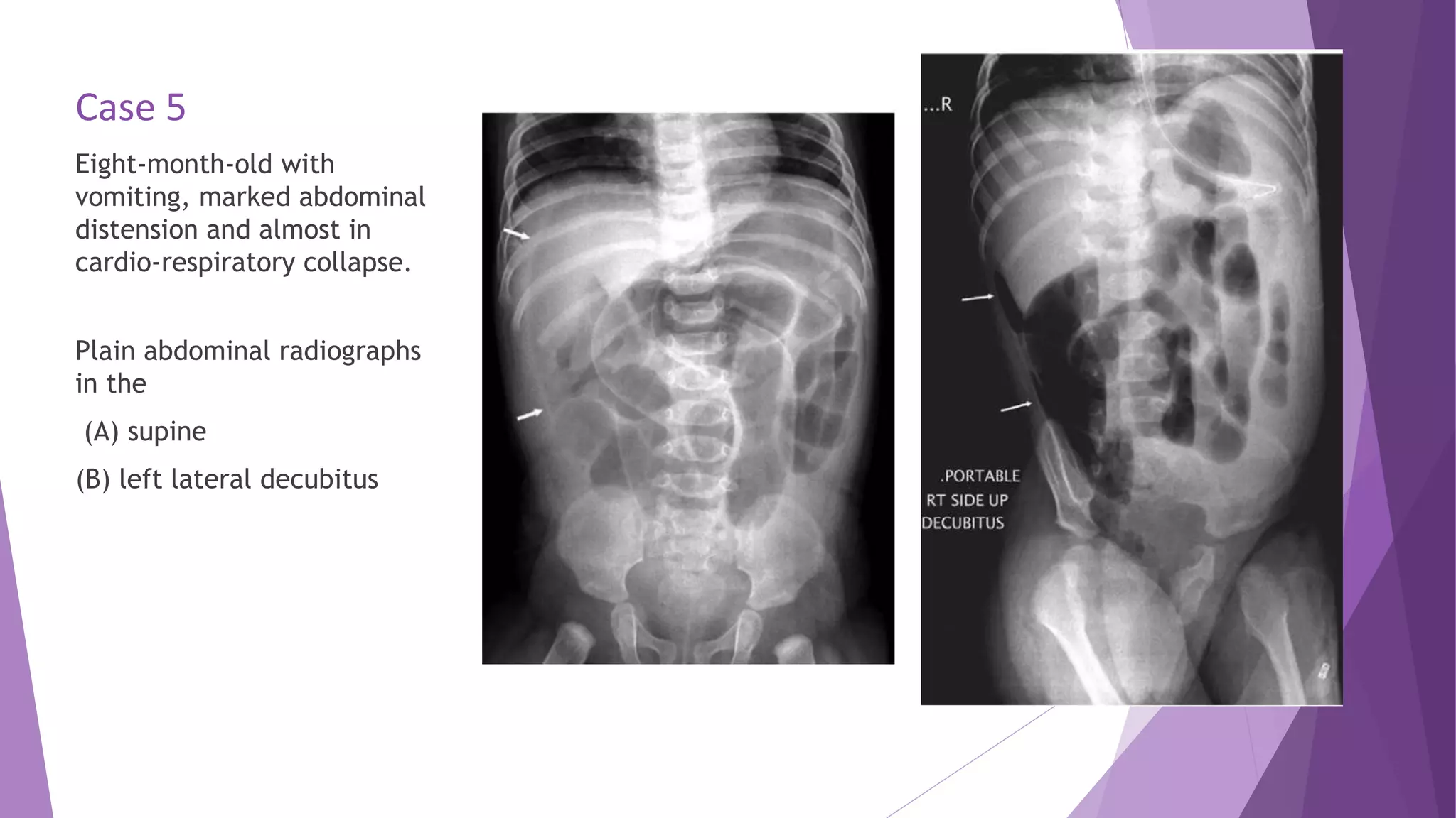 Paediatric abdominal x-ray-A key to diagnosis.pptx
