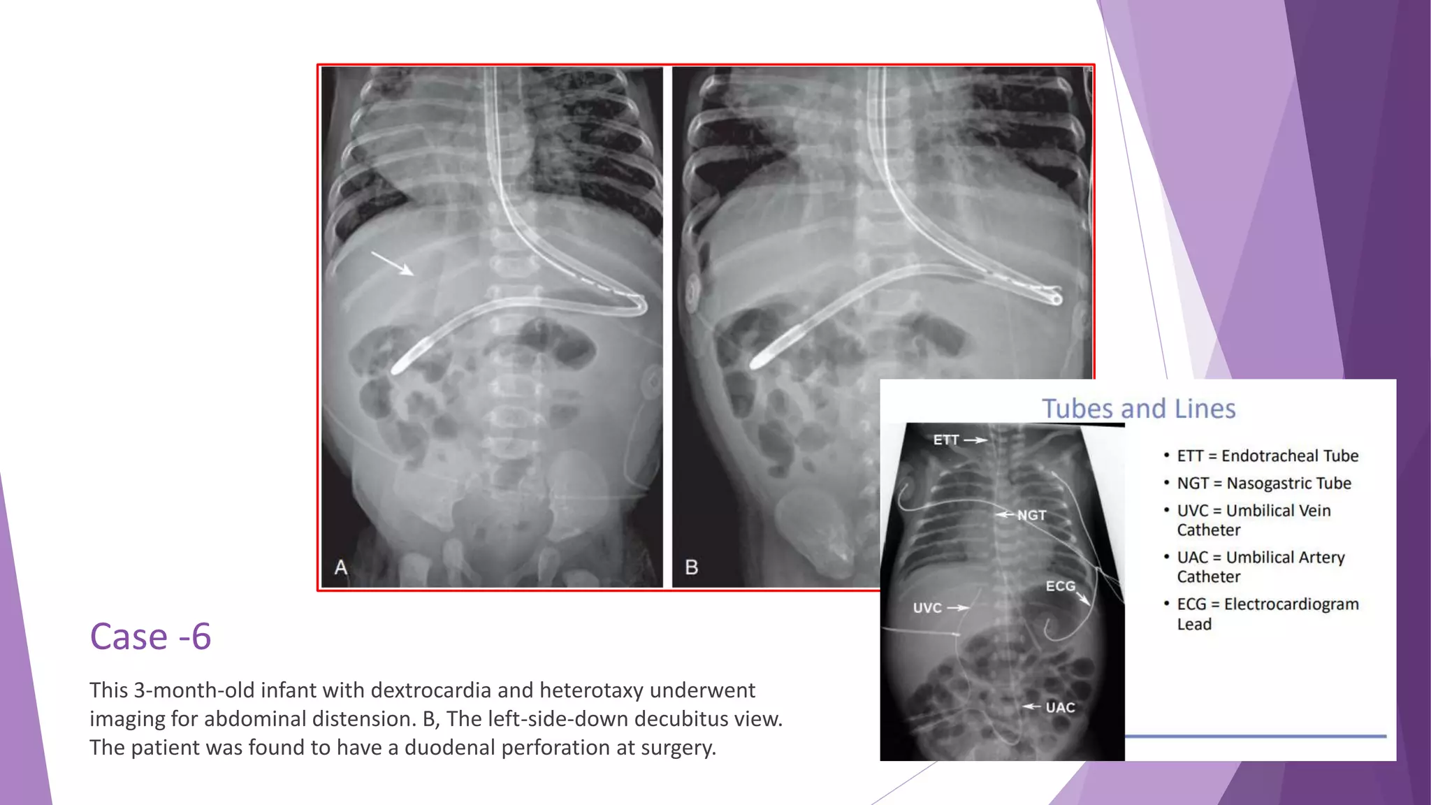 Paediatric abdominal x-ray-A key to diagnosis.pptx