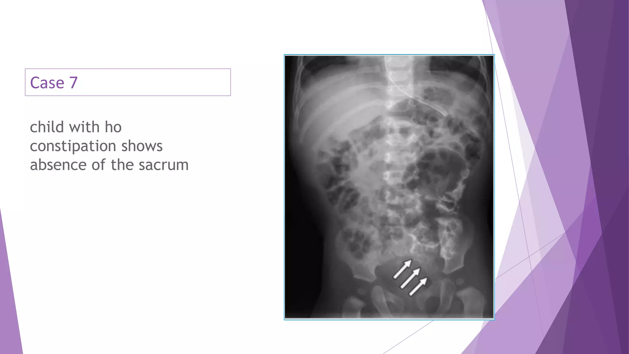 Paediatric abdominal x-ray-A key to diagnosis.pptx