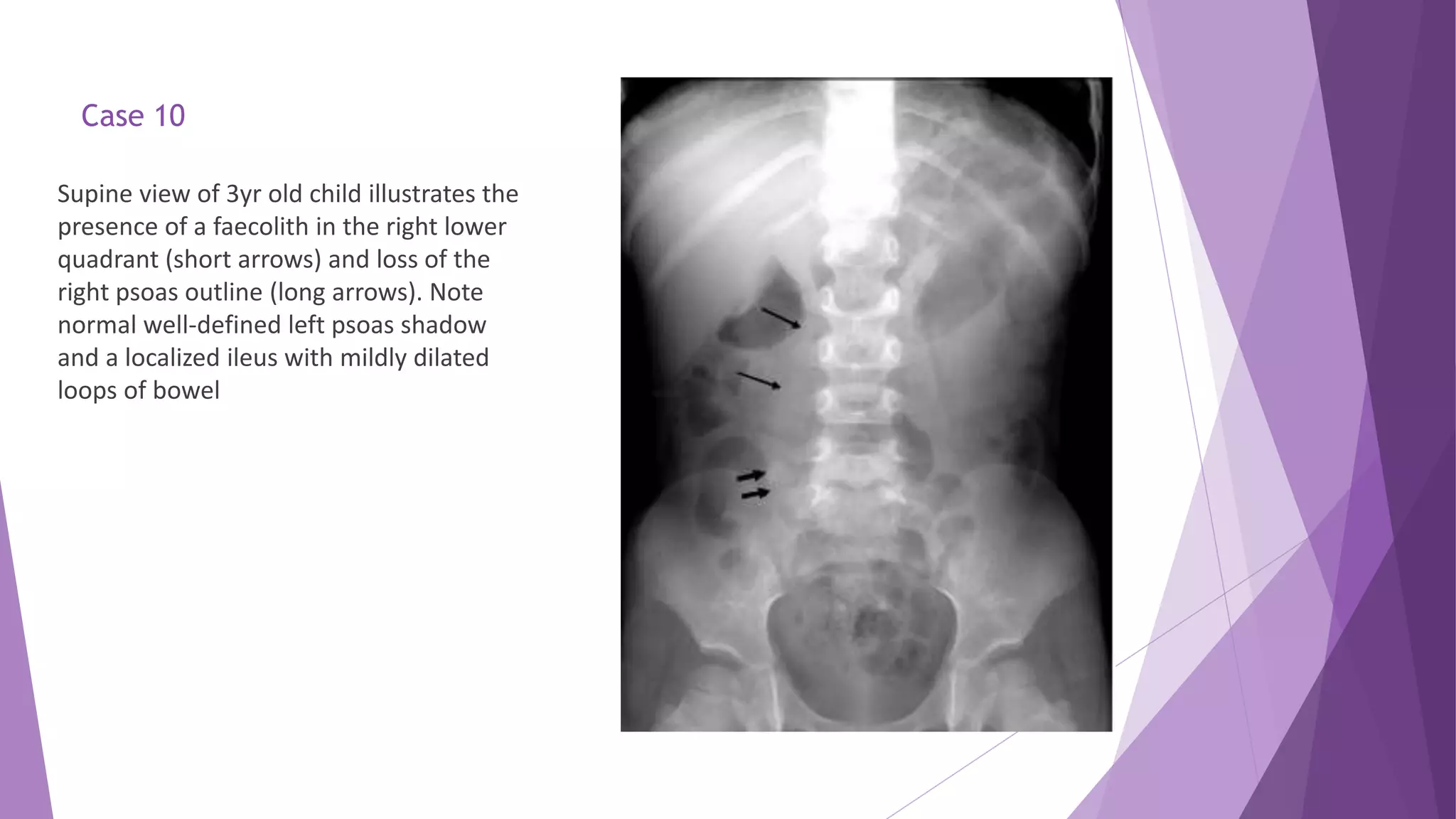 Paediatric abdominal x-ray-A key to diagnosis.pptx