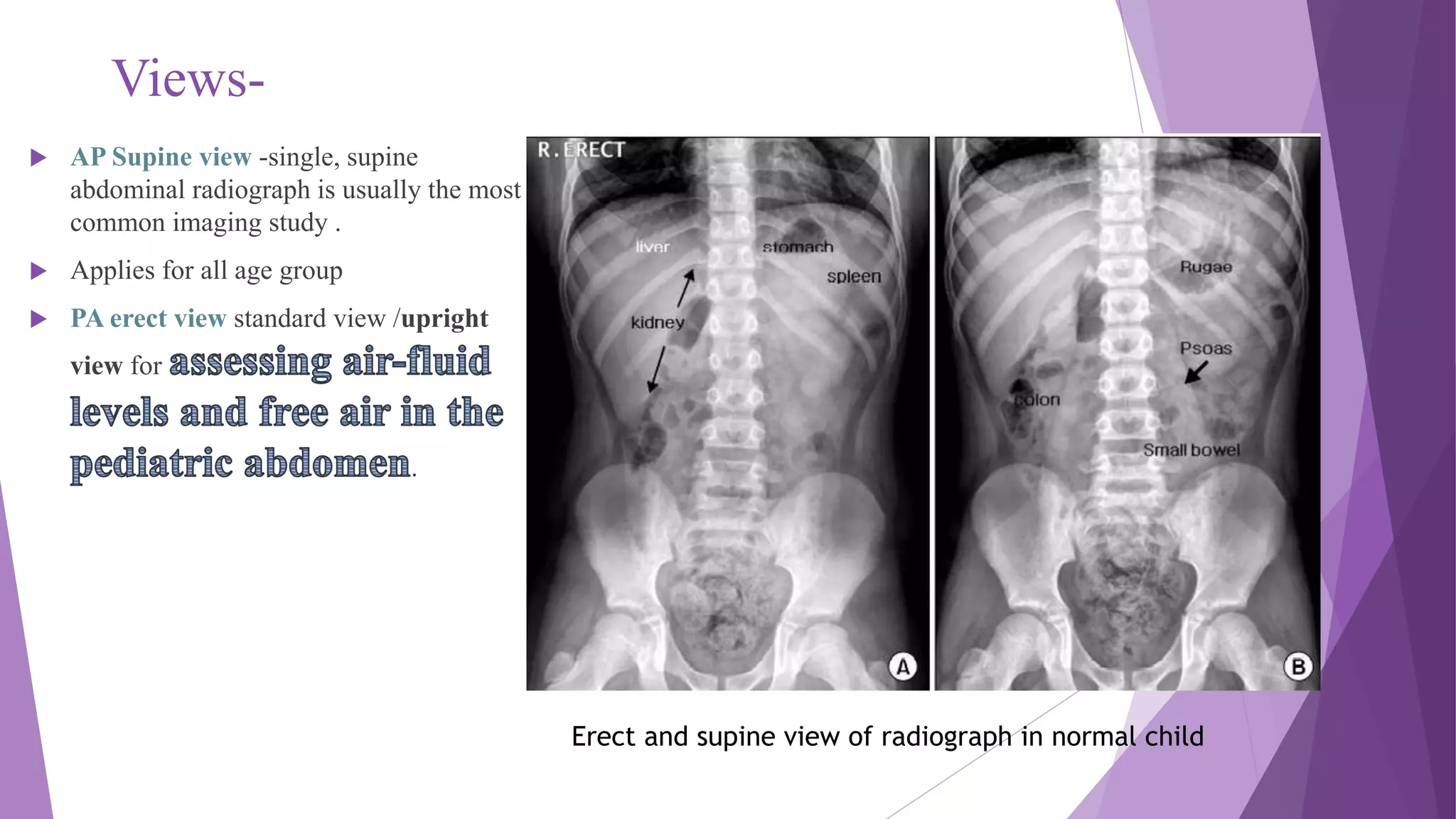 Paediatric abdominal x-ray-A key to diagnosis.pptx