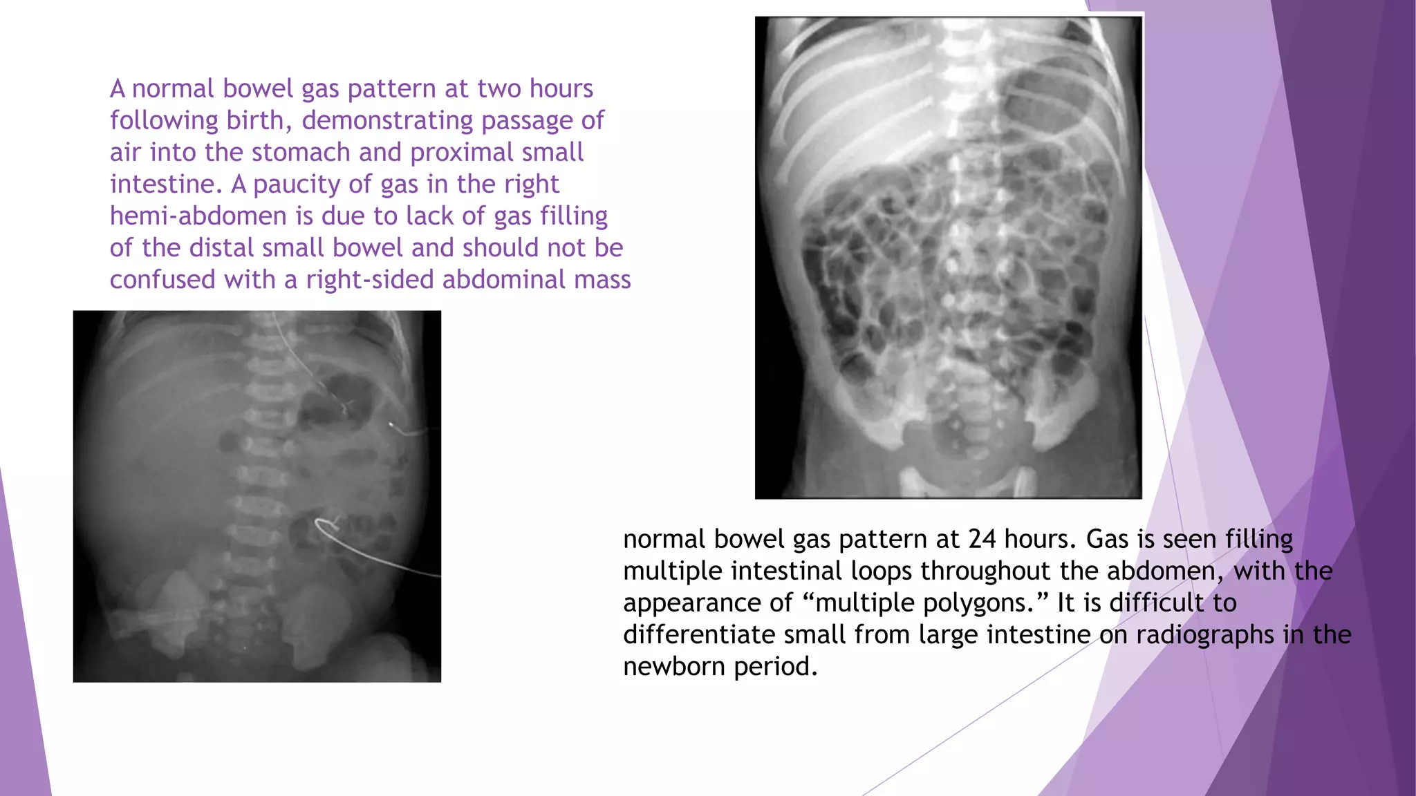 Paediatric abdominal x-ray-A key to diagnosis.pptx