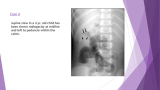 Paediatric abdominal x-ray-A key to diagnosis.pptx