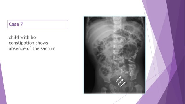 Paediatric abdominal x-ray-A key to diagnosis.pptx