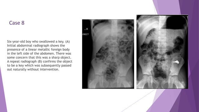 Paediatric abdominal x-ray-A key to diagnosis.pptx