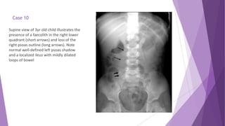 Paediatric abdominal x-ray-A key to diagnosis.pptx