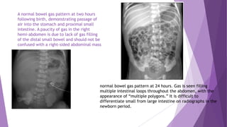 Paediatric abdominal x-ray-A key to diagnosis.pptx