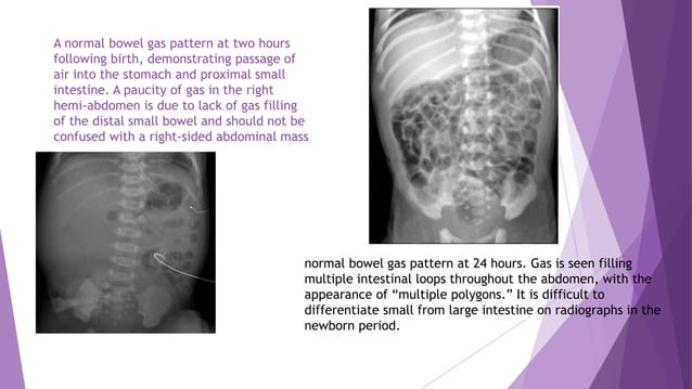 Paediatric abdominal x-ray-A key to diagnosis.pptx