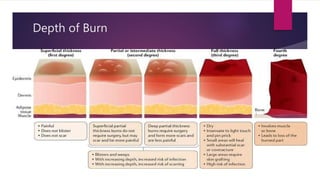 Paediatric burn management | PPTX