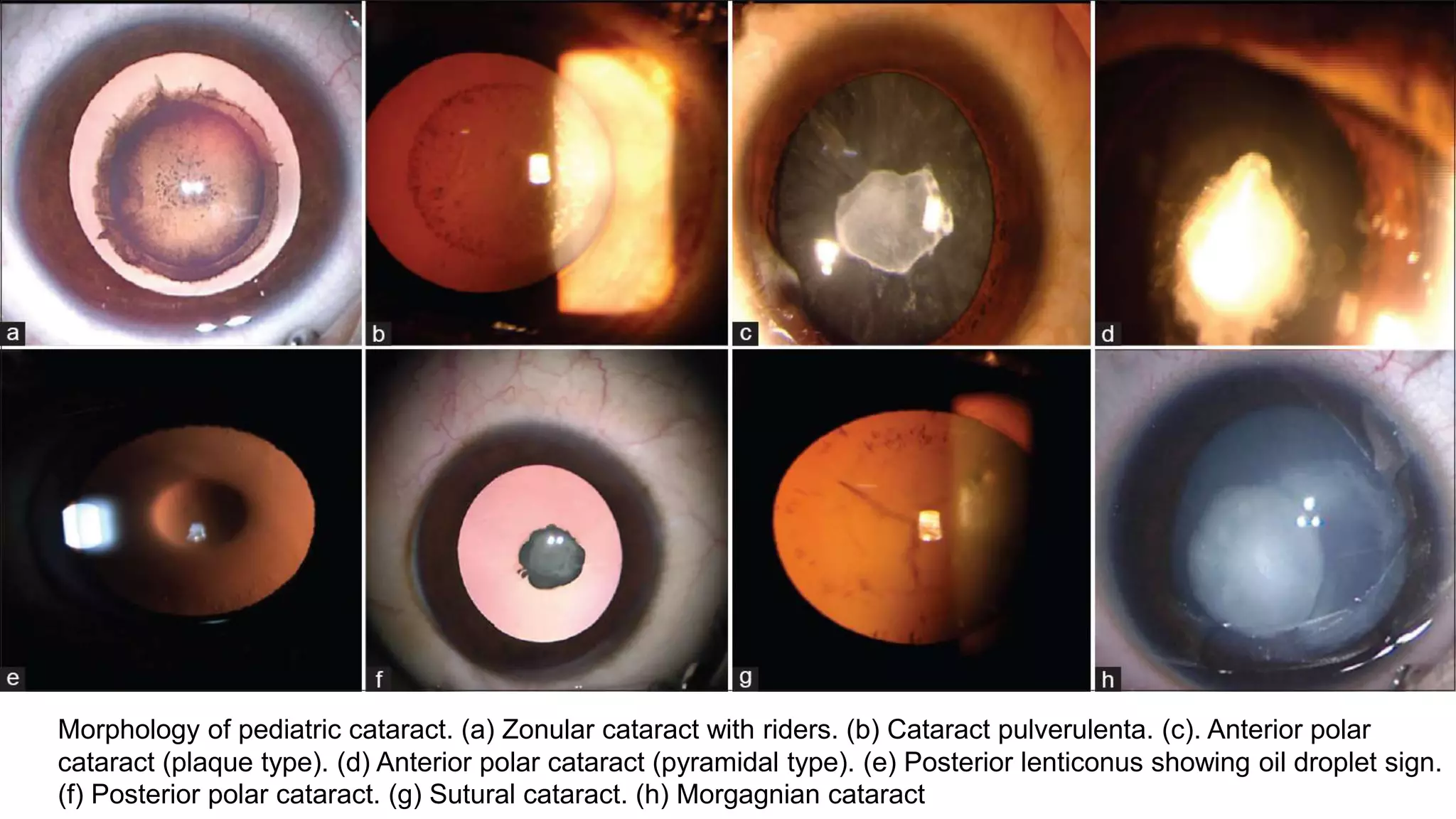 Paediatric cataract -DR ARNAV SAROYA | PPT