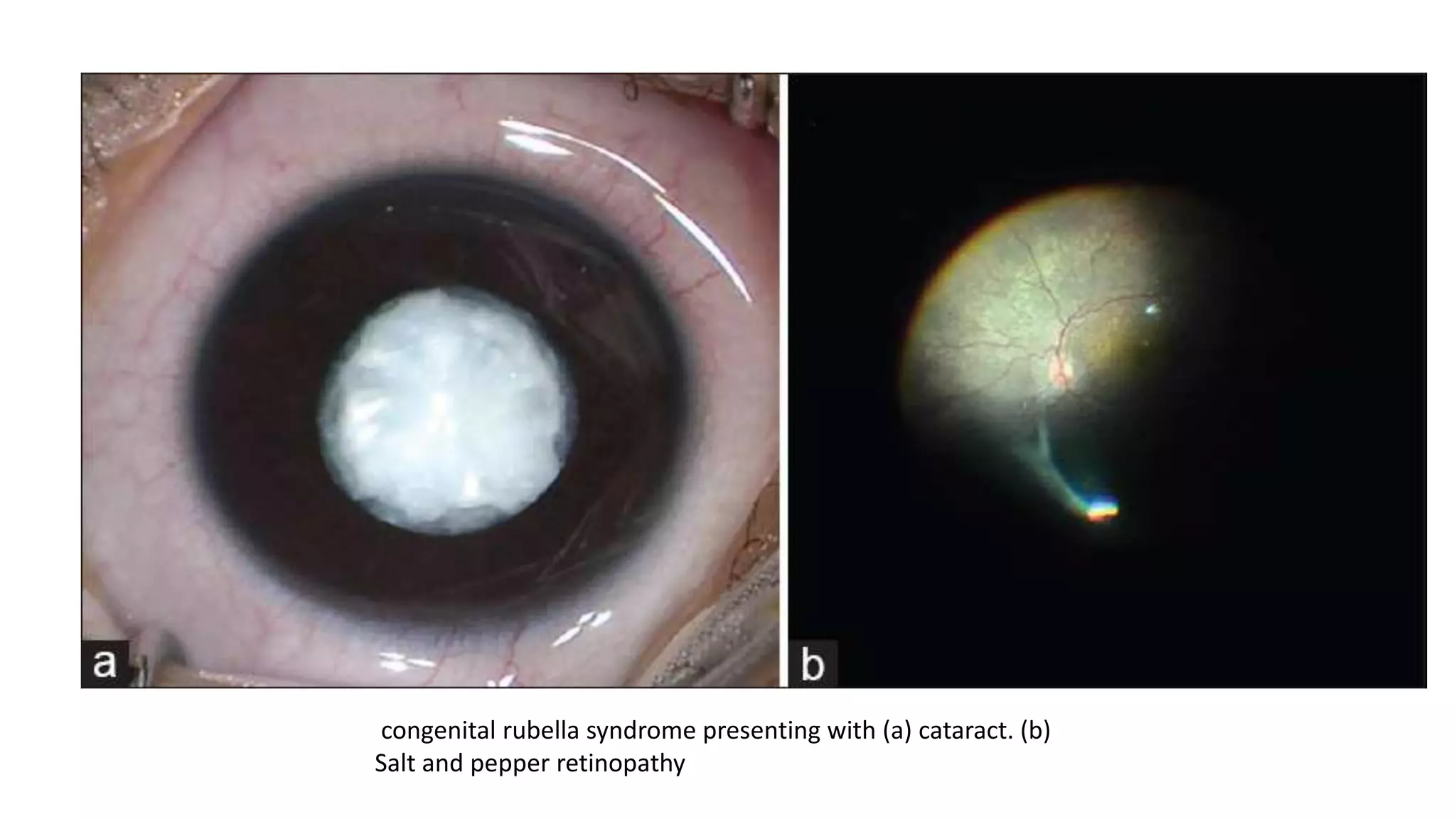 Paediatric cataract -DR ARNAV SAROYA | PPT