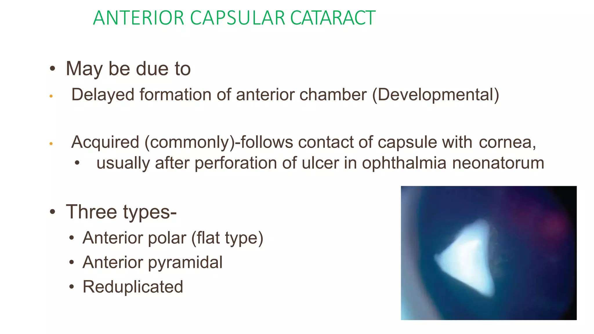 Paediatric cataract -DR ARNAV SAROYA | PPT