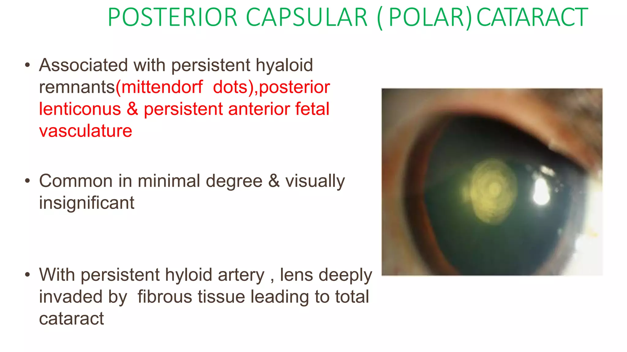 Paediatric cataract -DR ARNAV SAROYA | PPT