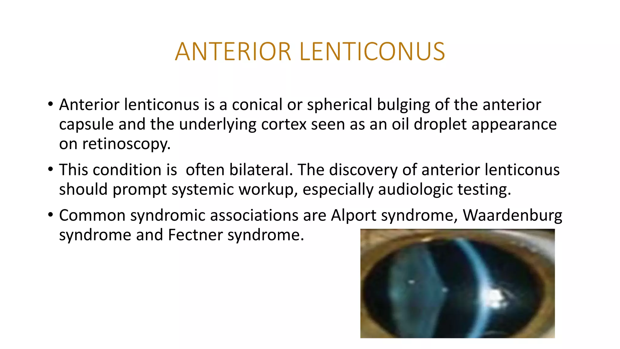 Paediatric cataract -DR ARNAV SAROYA | PPT