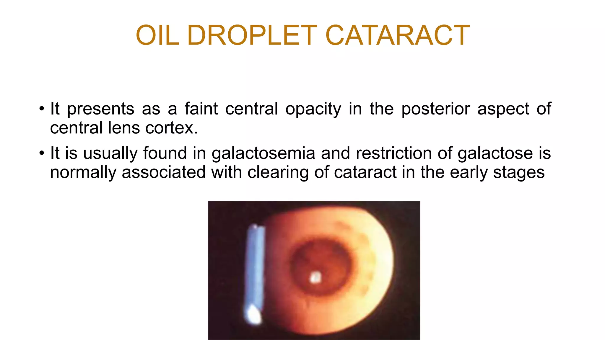 Paediatric cataract -DR ARNAV SAROYA | PPT
