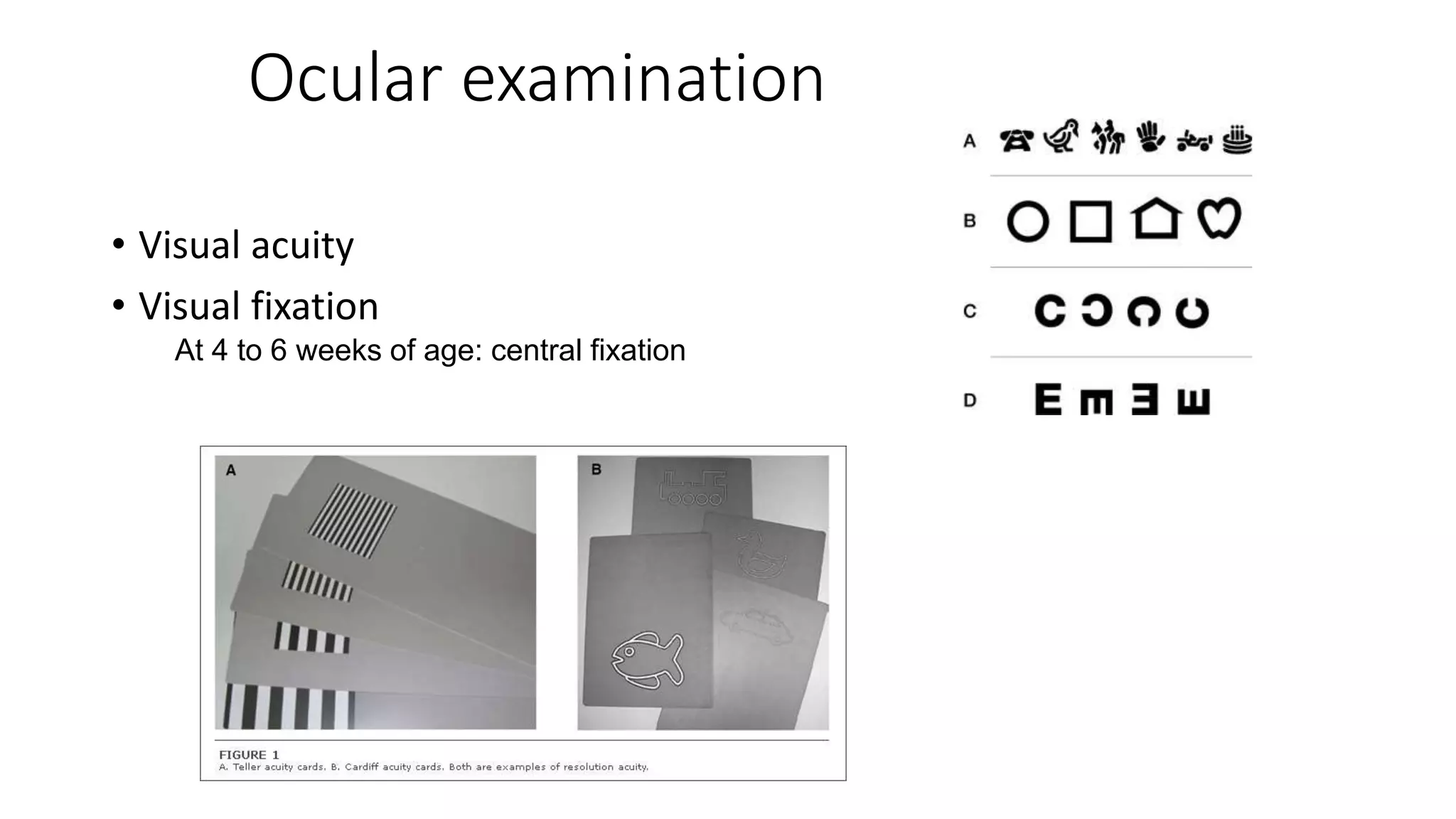 Paediatric cataract -DR ARNAV SAROYA | PPT