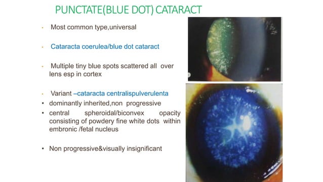 Paediatric cataract -DR ARNAV SAROYA | PPT | Eye and Vision Conditions ...