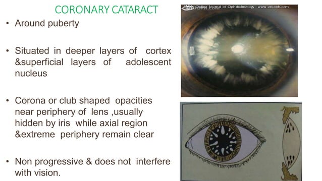 Paediatric cataract -DR ARNAV SAROYA | PPT | Eye and Vision Conditions ...