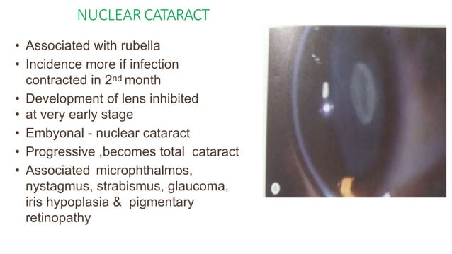 Paediatric cataract -DR ARNAV SAROYA | PPT | Eye and Vision Conditions ...