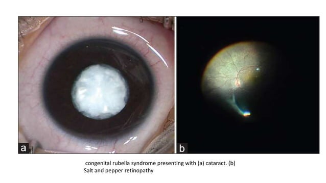 Paediatric cataract -DR ARNAV SAROYA | PPT | Eye and Vision Conditions ...