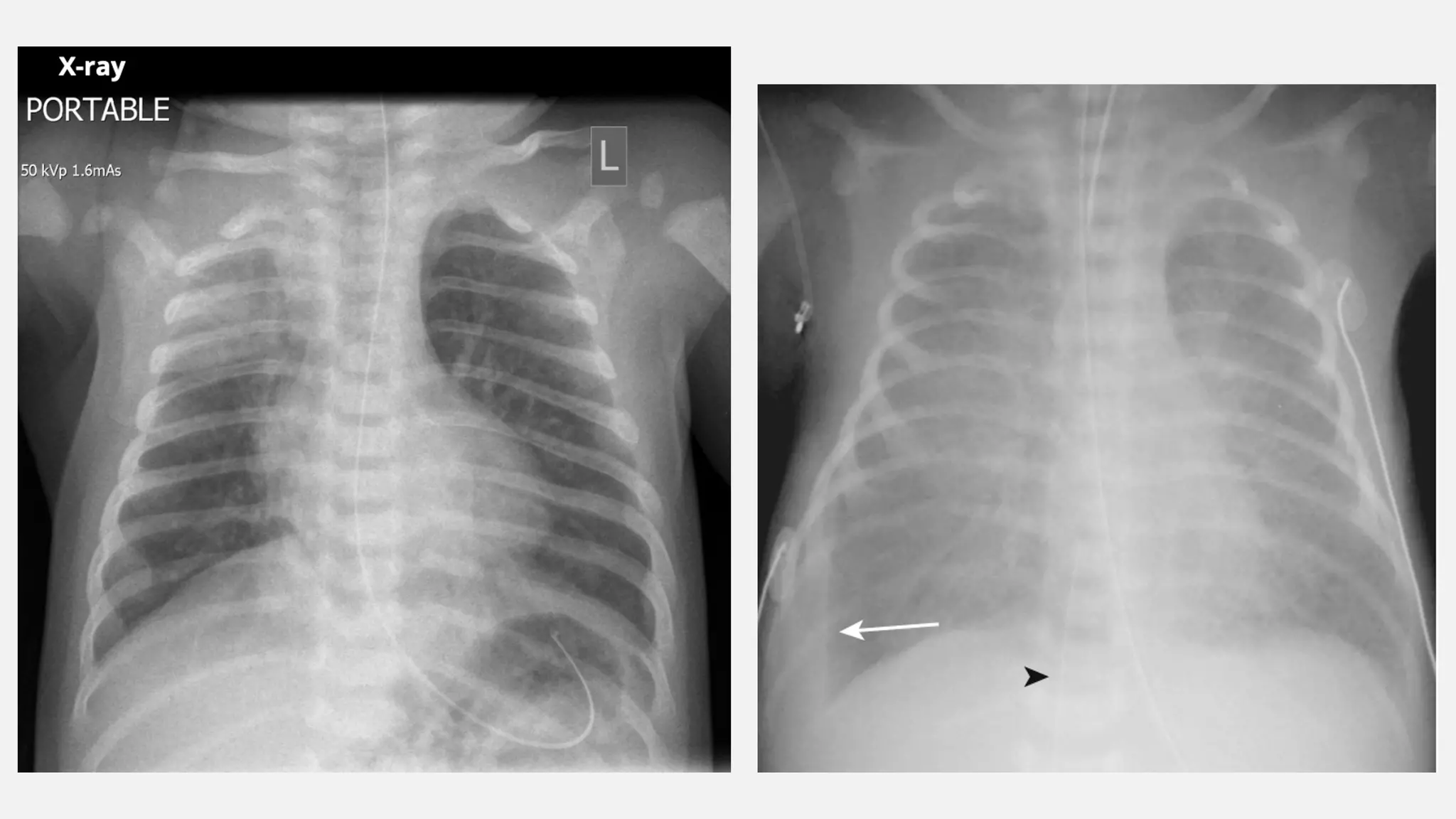 Paediatric chest 031220 | PDF