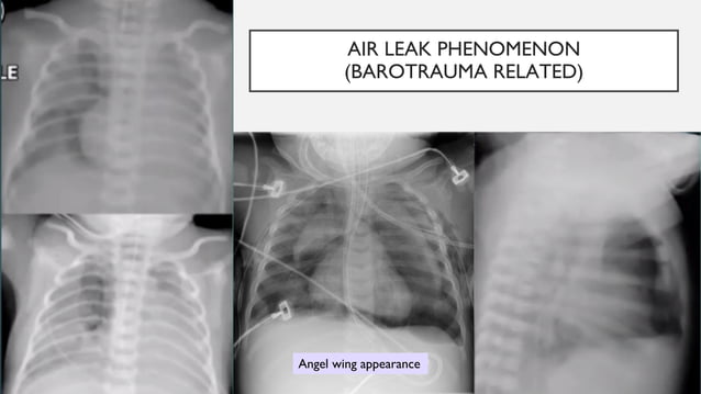 Paediatric chest 031220 | PDF