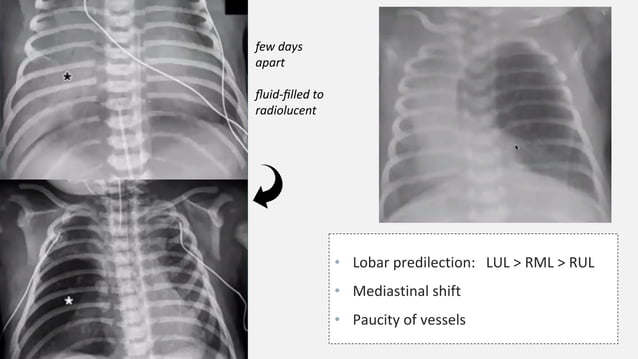 Paediatric chest 031220 | PDF