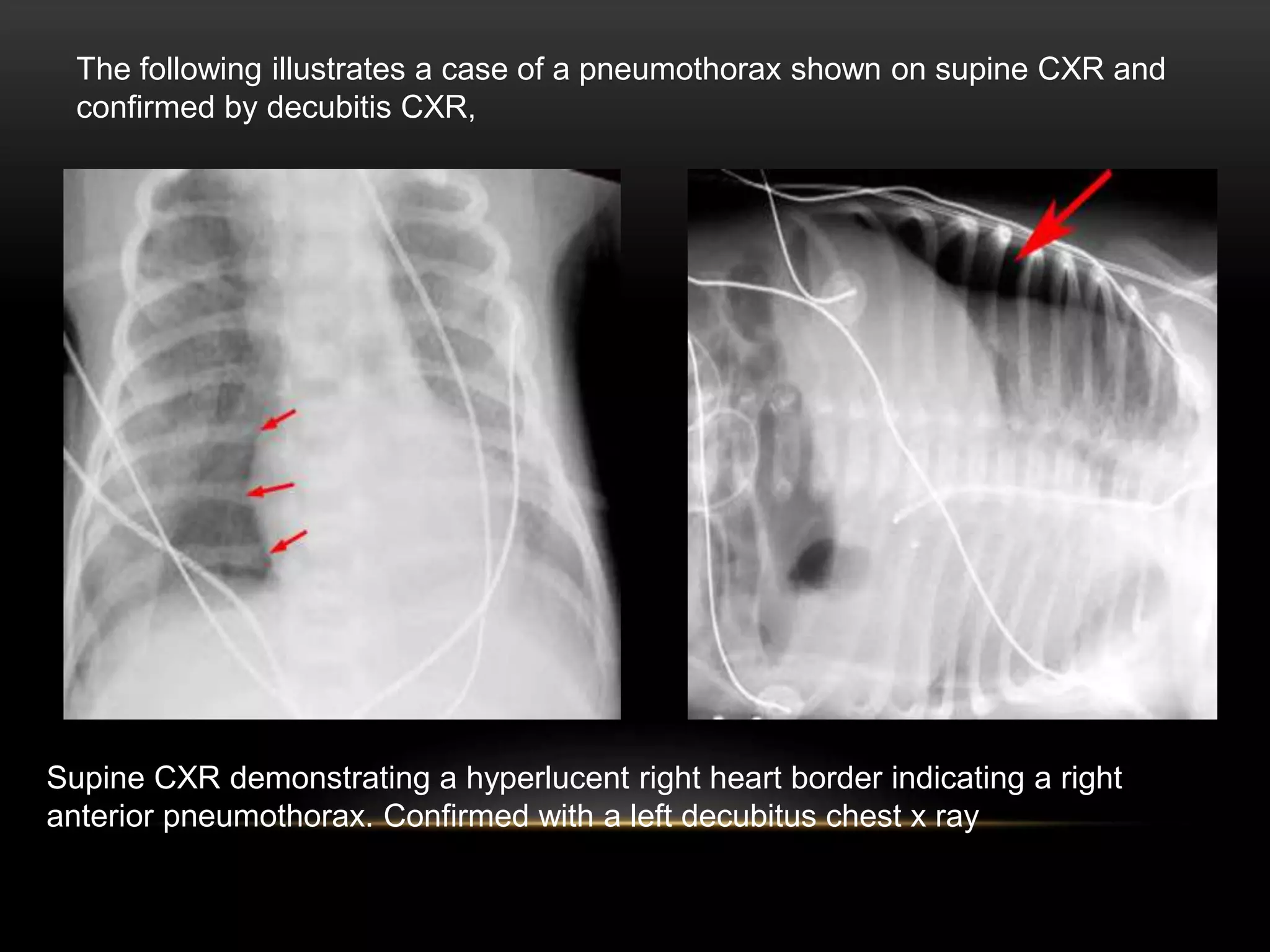 Paediatric chest imaging | PPTX
