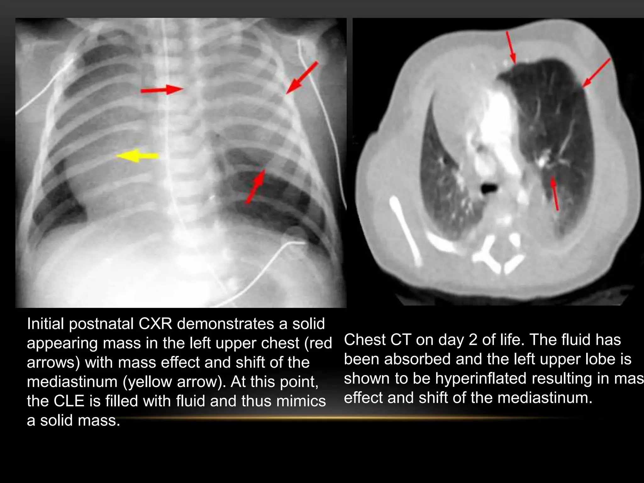 Paediatric chest imaging | PPTX