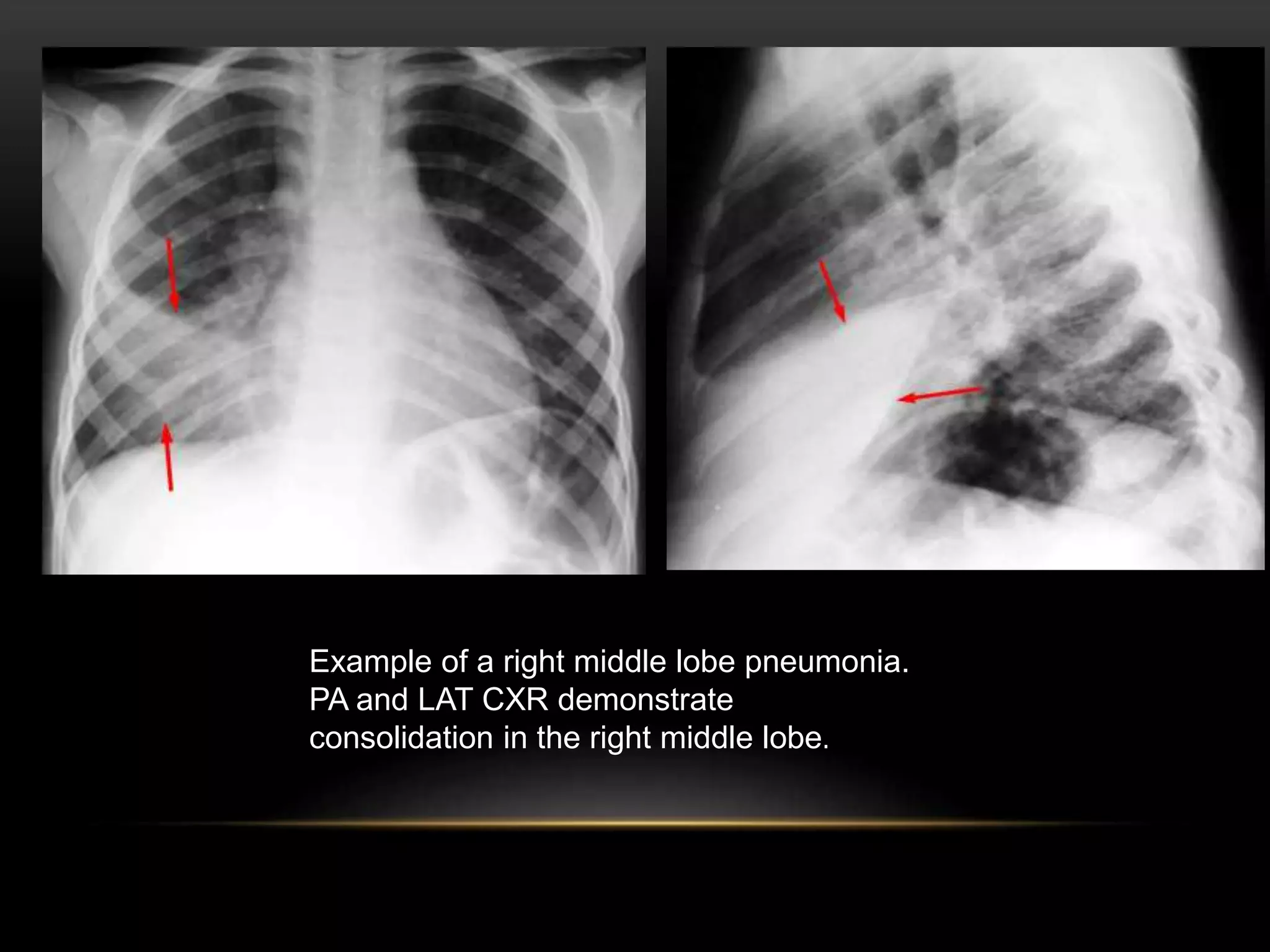 Paediatric chest imaging | PPTX