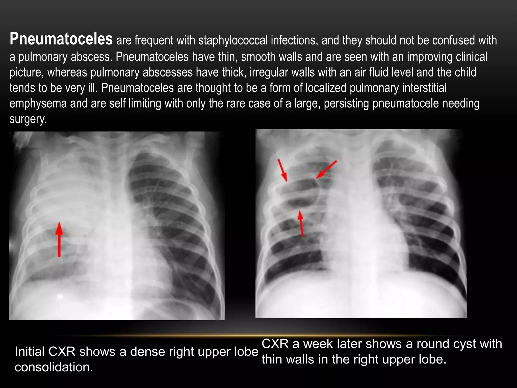Paediatric chest imaging | PPTX