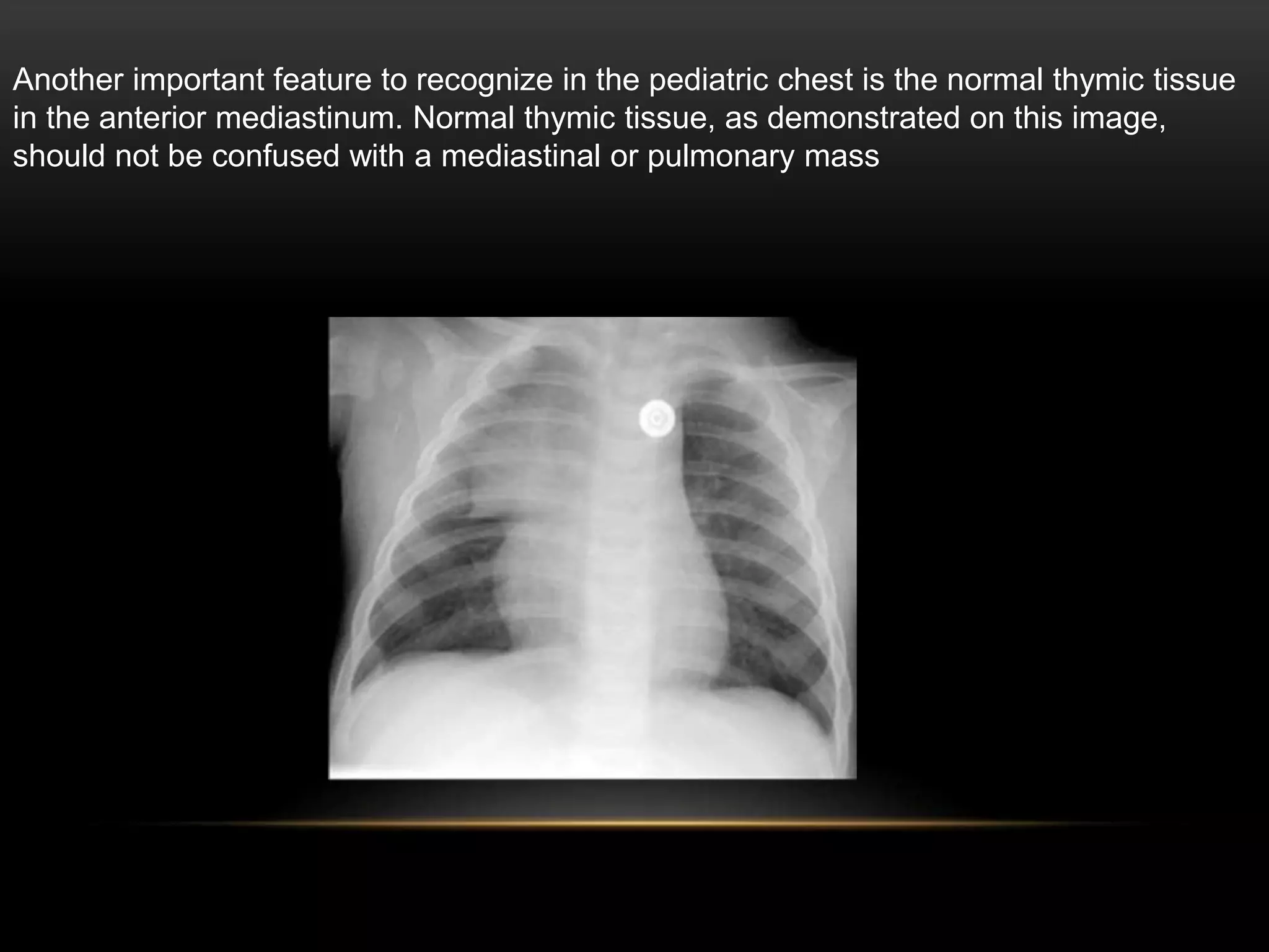 Paediatric chest imaging | PPTX