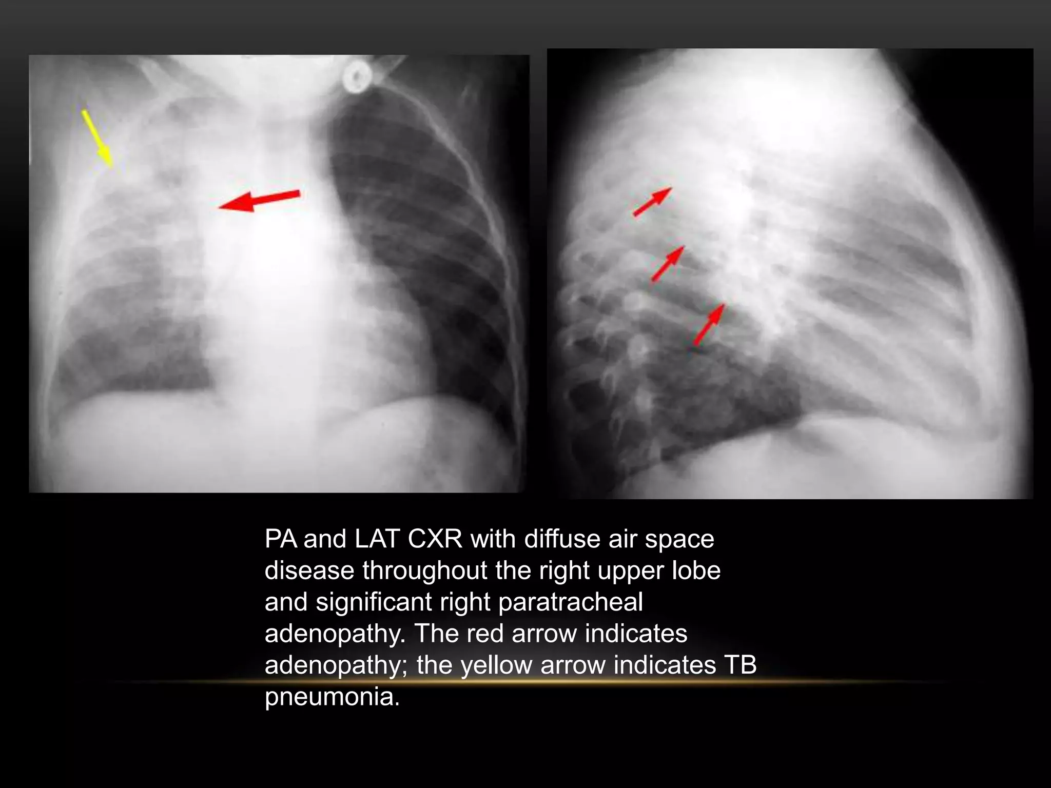Paediatric chest imaging | PPTX