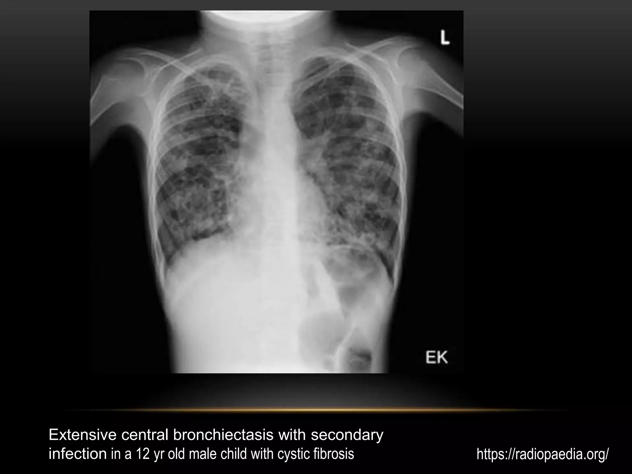 Paediatric chest imaging | PPTX