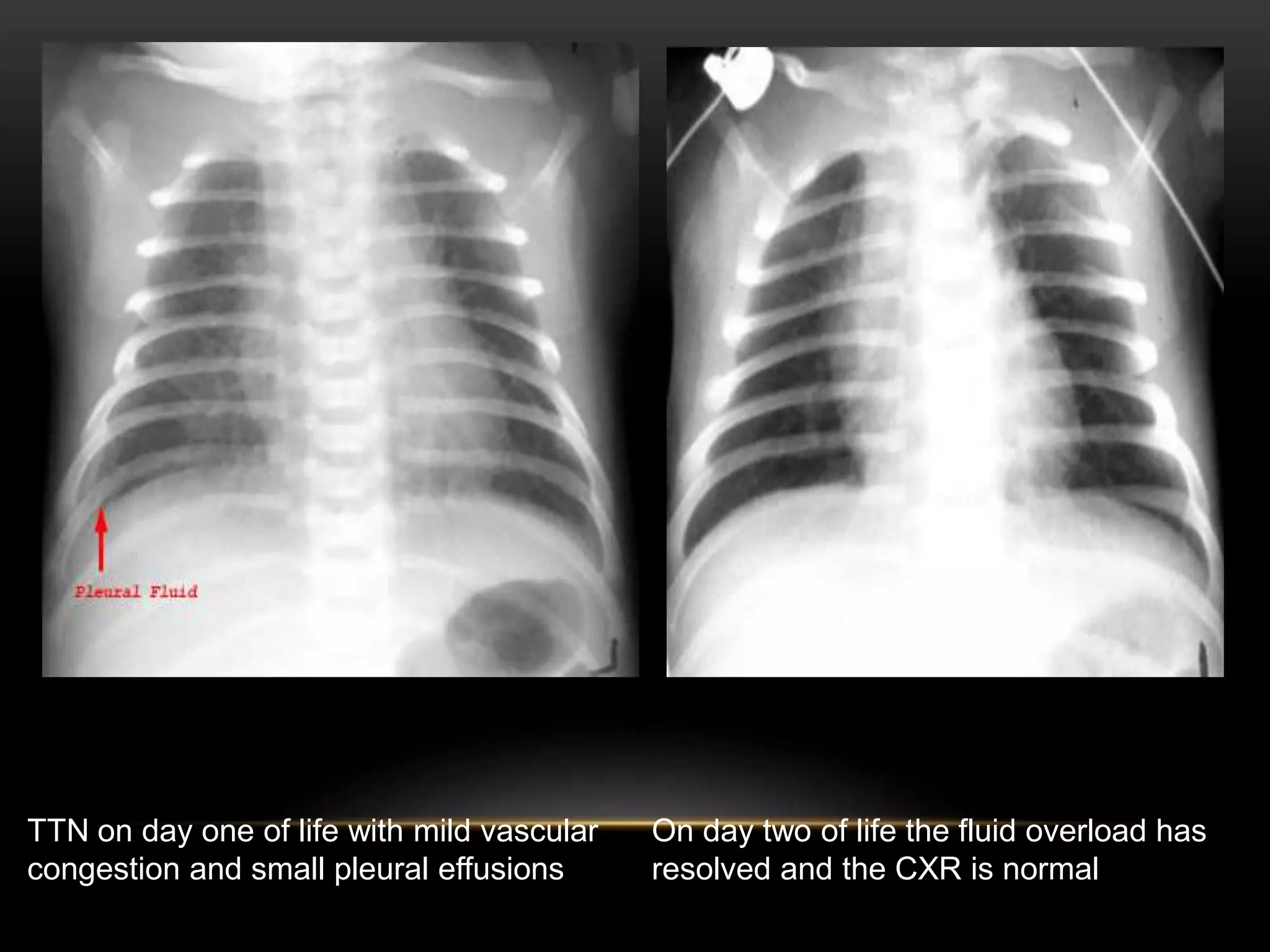 Paediatric chest imaging | PPTX