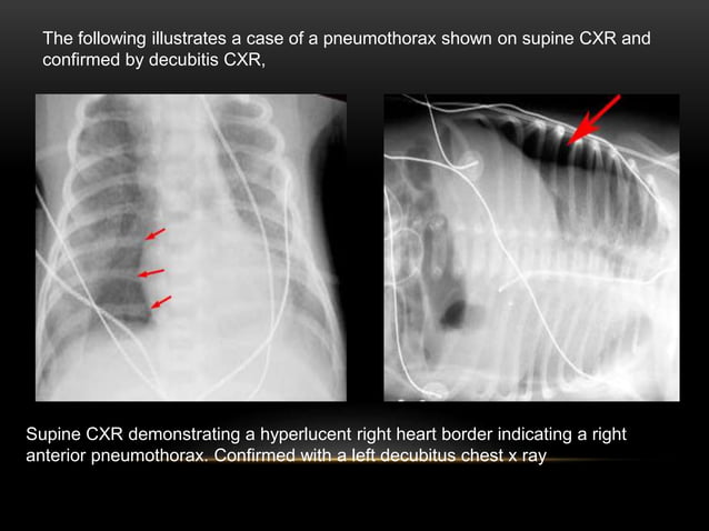 Paediatric chest imaging | PPTX | Lung and Respiratory Health ...