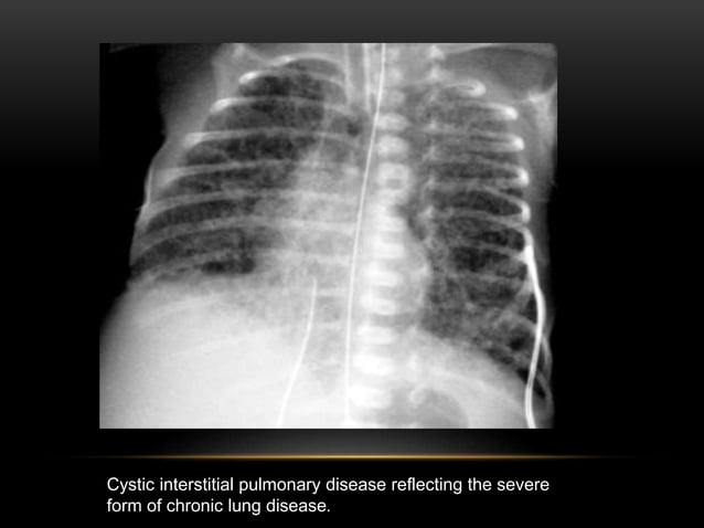 Paediatric chest imaging | PPTX | Lung and Respiratory Health ...