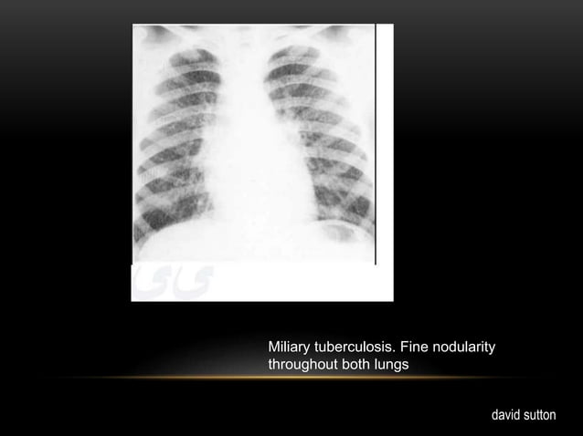 Paediatric chest imaging | PPTX | Lung and Respiratory Health ...